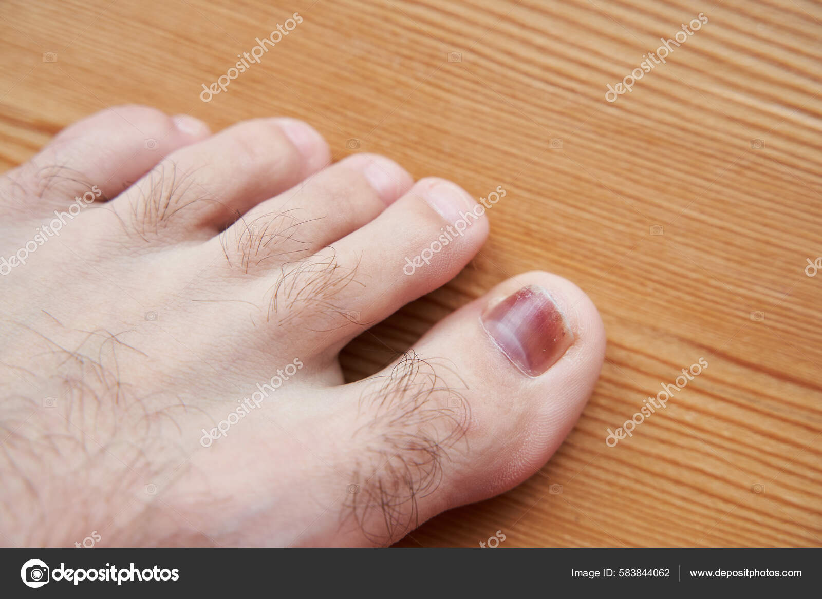 Toe Injured Heavy Object Has Fallen Finger Hematoma Nail — Stock Photo ...