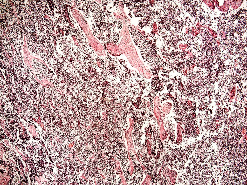 Small-cell lung cancer of a human — Stock Photo © bond80 #22004181