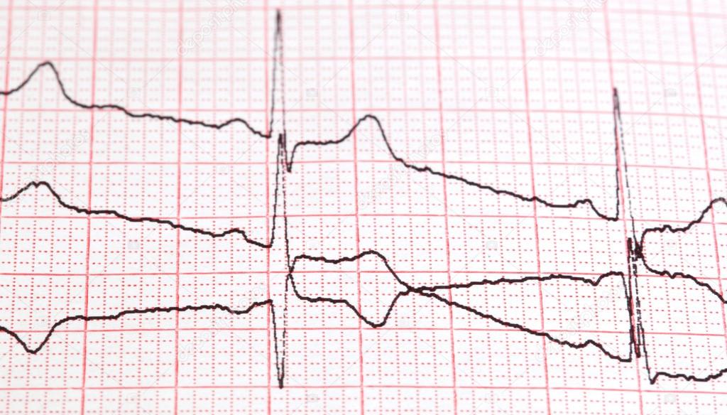 Cardiogram Stock Photo by ©pakhay 25954355
