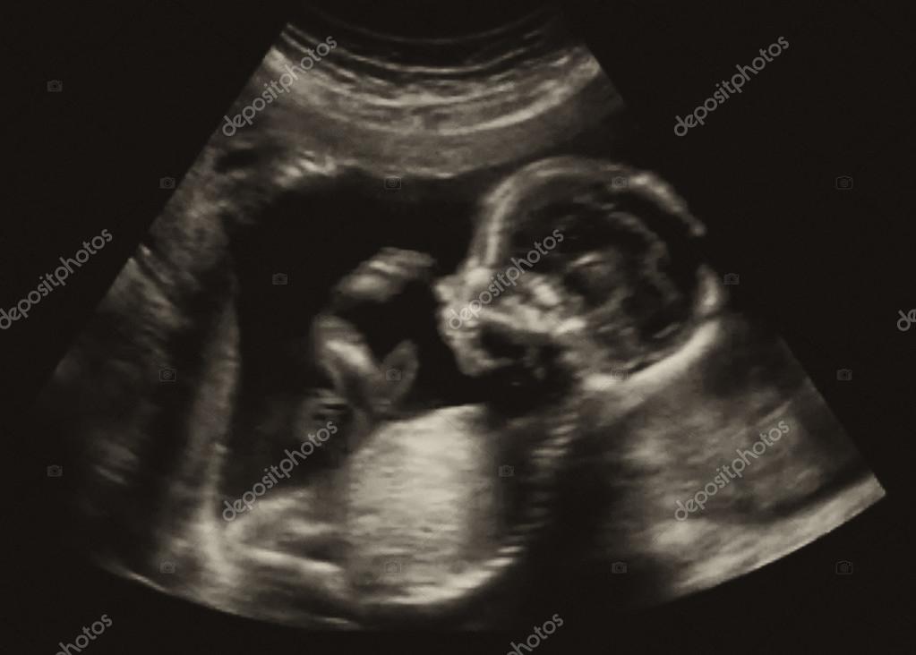 Obstetric Ultrasonography Ultrasound Echography of a first month Stock ...