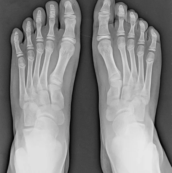 Foot X Ray Normal