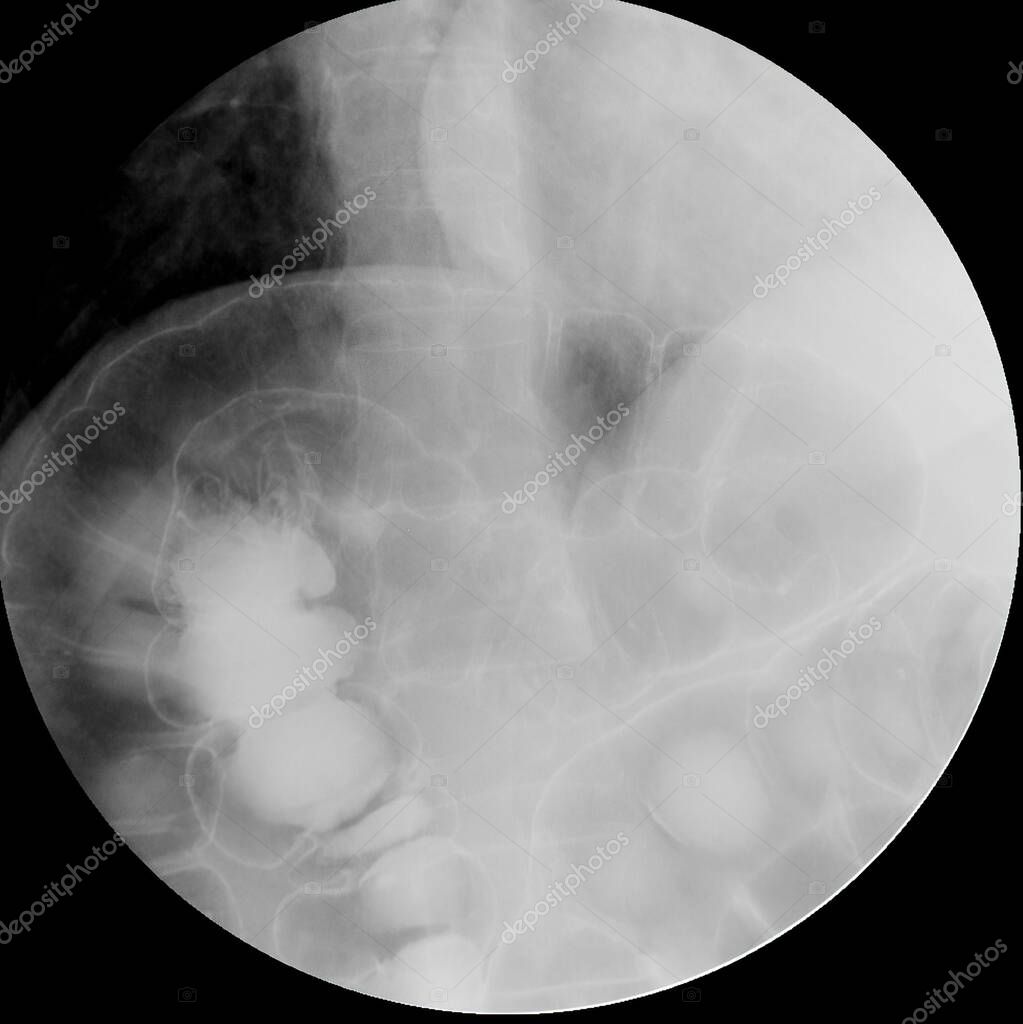 Imagen de enema de bario o vista de rayos X colorrectales que muestra ...