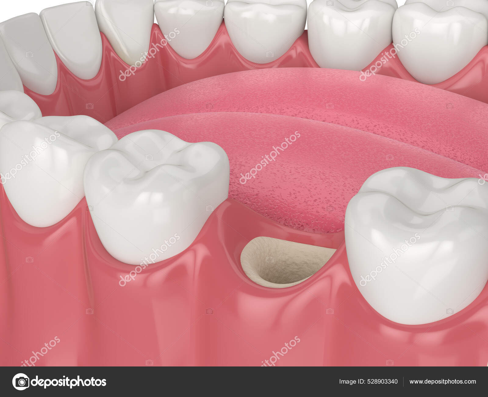 Render Jaw Empty Socket Ready Dental Bone Grafting Stock Photo by ...