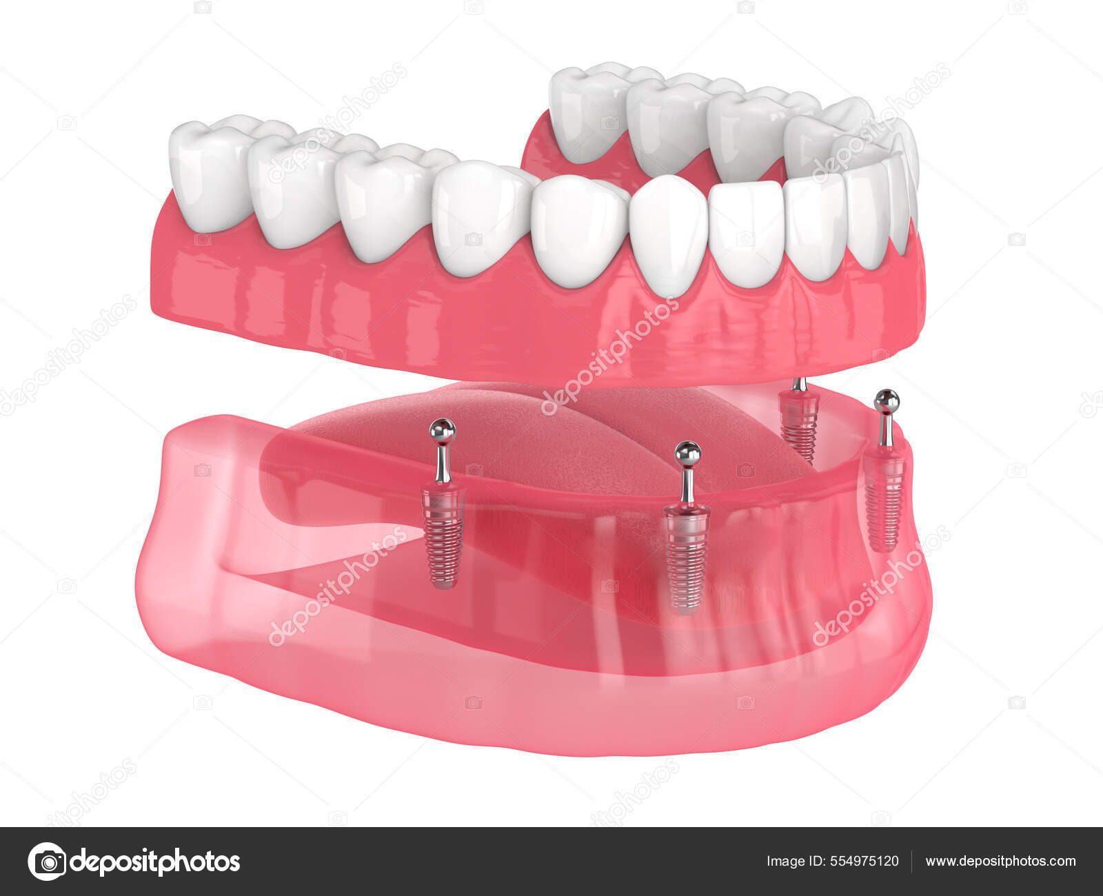 All Removable Implants Supported Overdenture Installation White ...