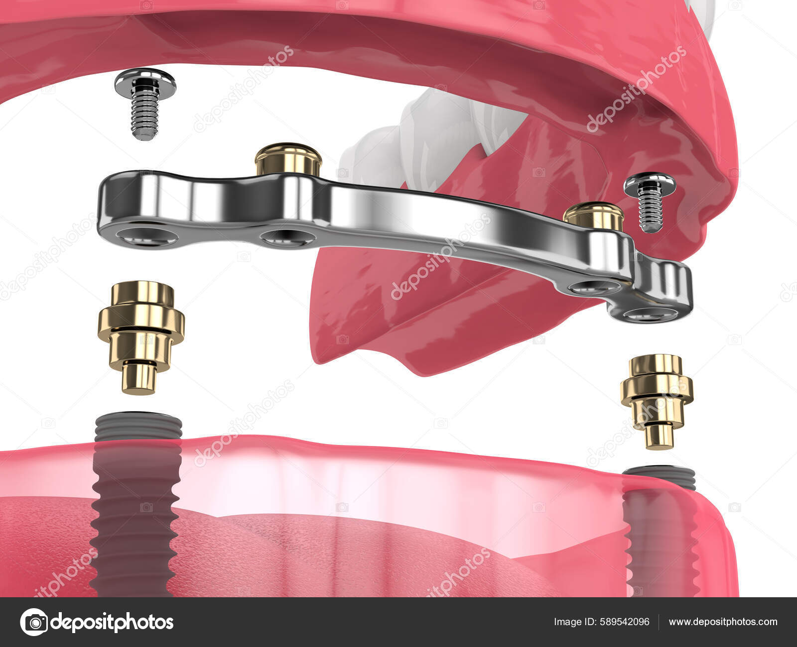 Render Bar Retained Removable Overdenture Installation Supported Two ...