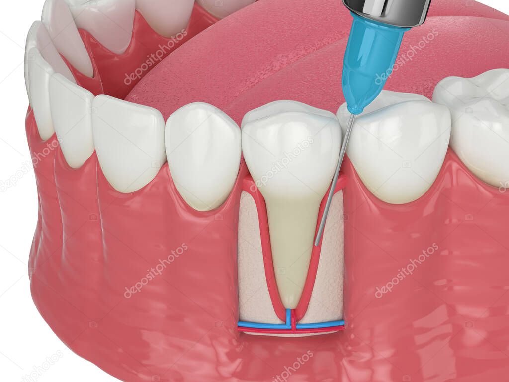 3d renderizado de mandíbula humana con procedimiento de anestesia ...