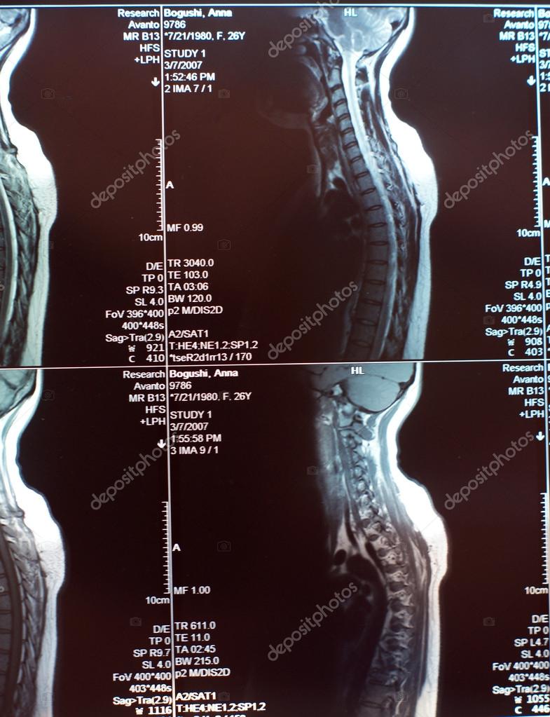 X-Ray of a human spine, a vertical picture Stock Photo by ©Elet_1 13378339