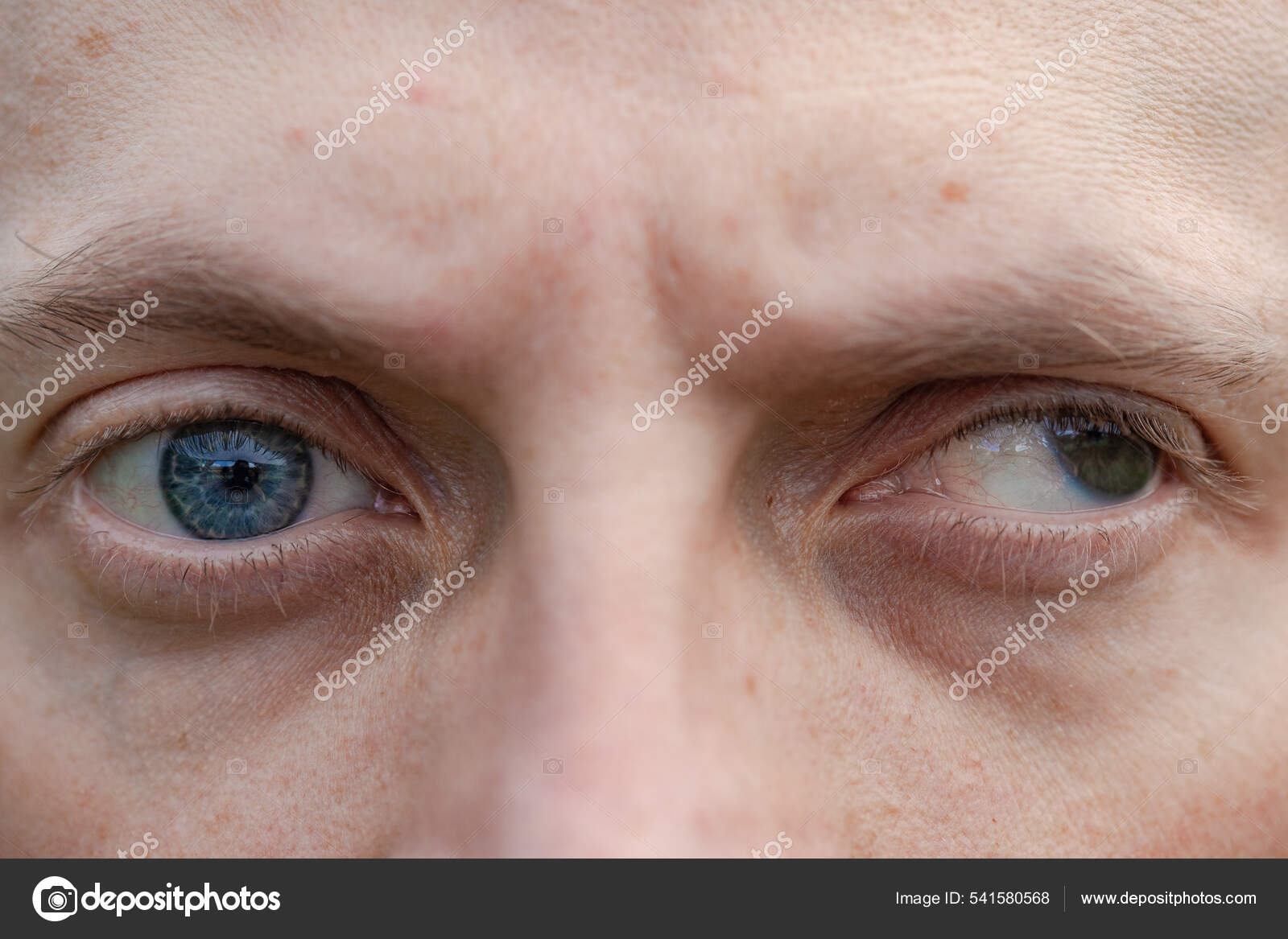 Strabismus Man Well Blindness One Eye Congenital Vision Problems Visual ...