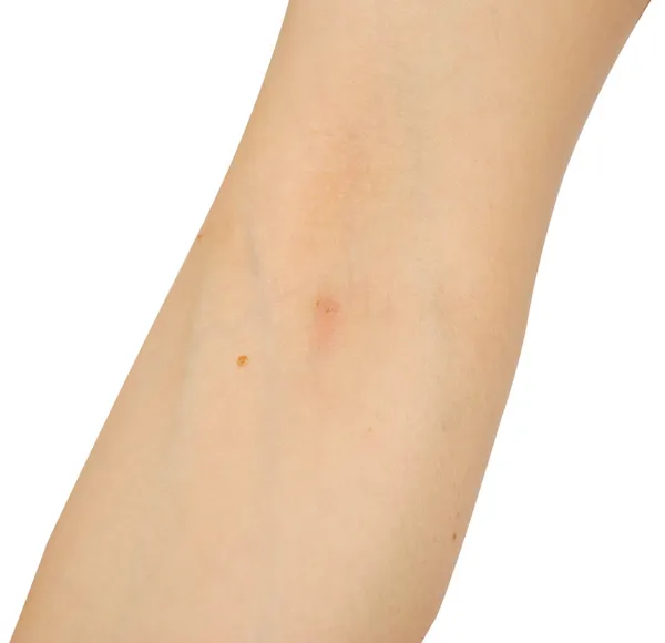 Erythema arm Stock Photos, Royalty Free Erythema arm Images | Depositphotos