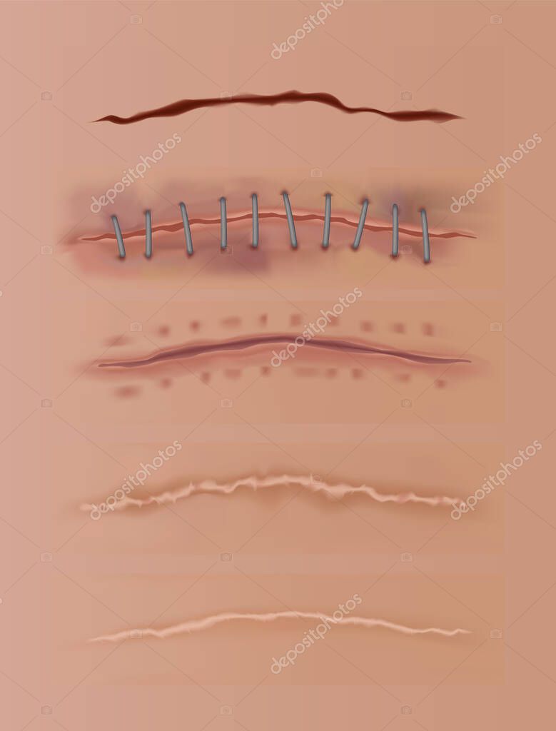 Conjunto de heridas curativas, cicatrices en la piel, herida cosida y ...