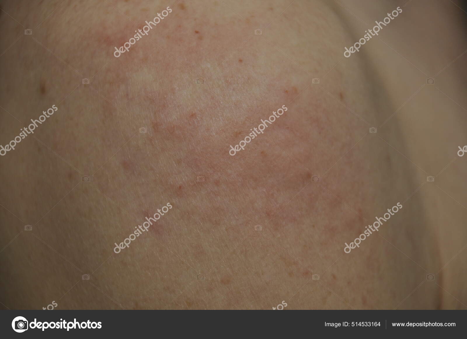 Eczema Pimples Shoulder — Stock Photo © BZH2224 #514533164