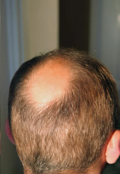 Bald in the sun - Stock Image - Everypixel