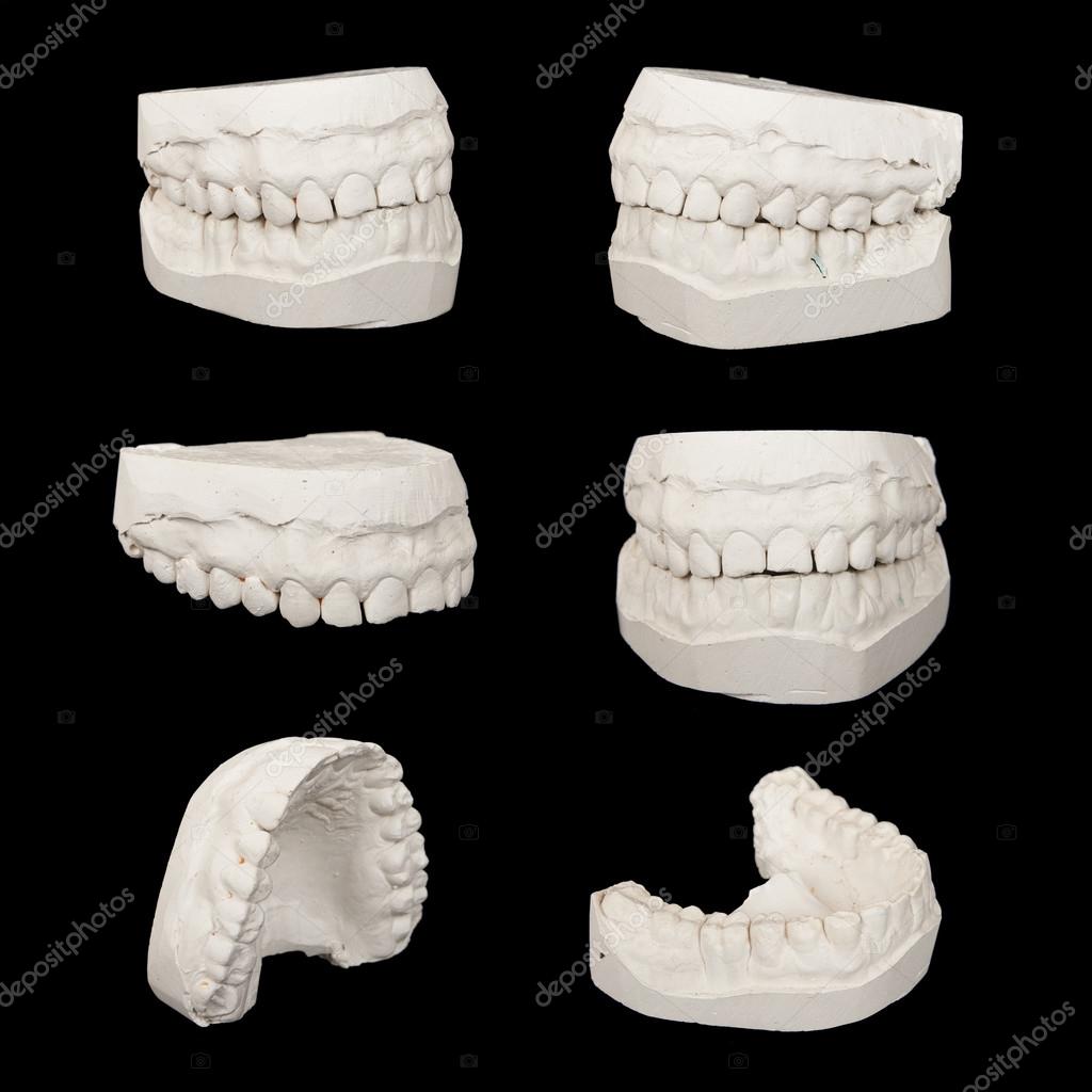 Conjunto de modelos de yeso de fundición dental yeso fundido ...