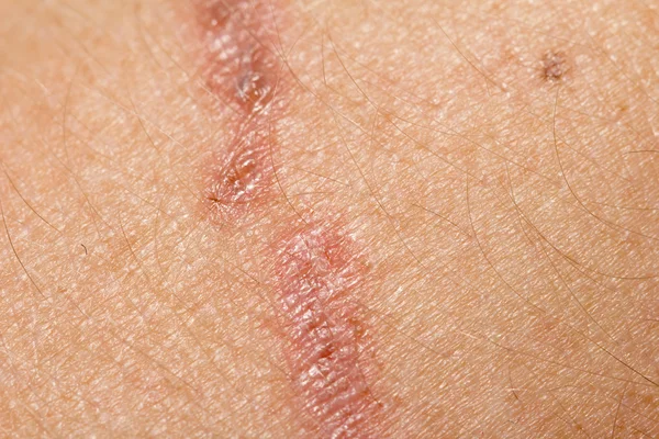 Human scab Stock Photos, Royalty Free Human scab Images | Depositphotos