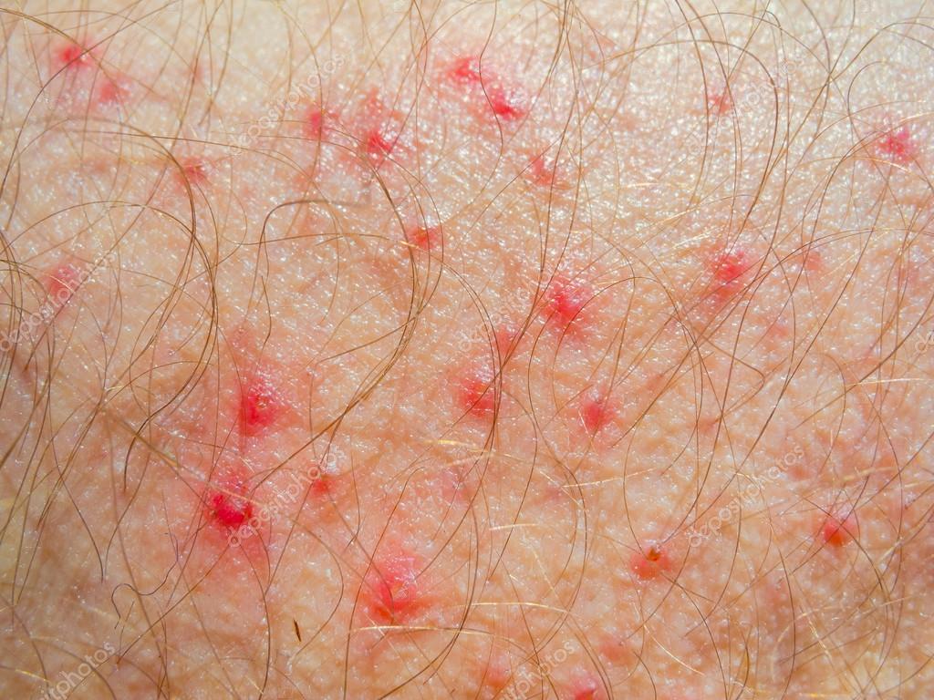 Allergic reaction — Stock Photo © toxawww #30535807