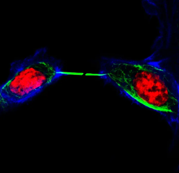 Epithelial tumor cells labeled with fluorescent molecules — Stock Photo ...