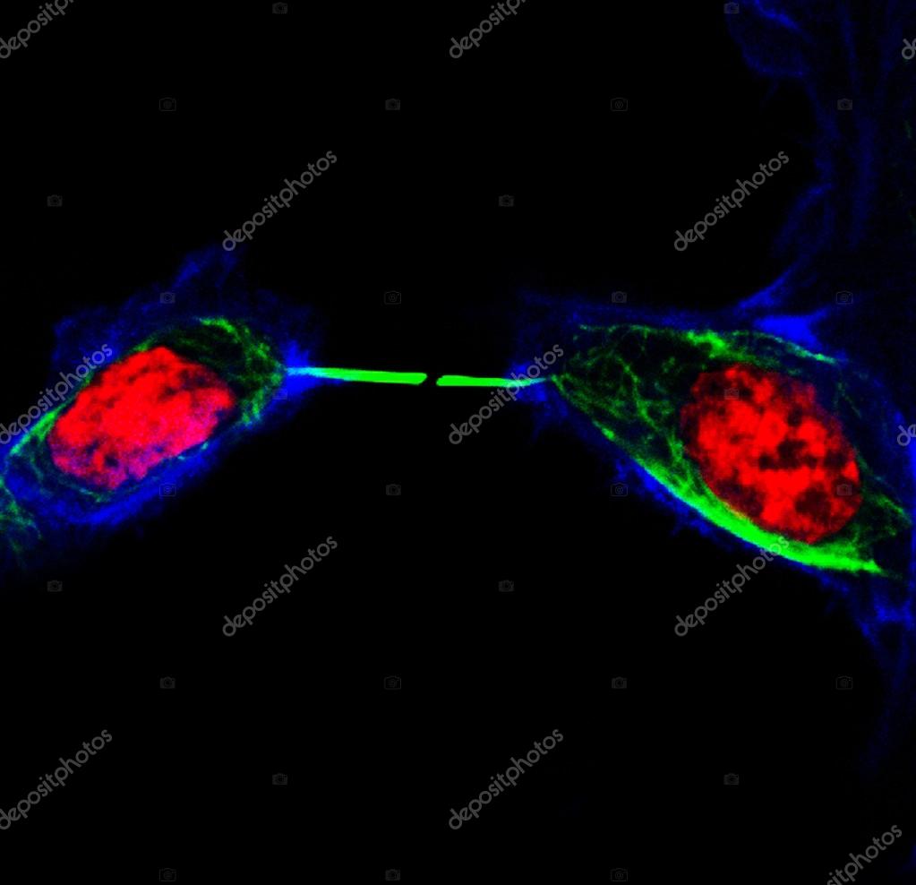 Epithelial tumor cells labeled with fluorescent molecules — Stock Photo ...