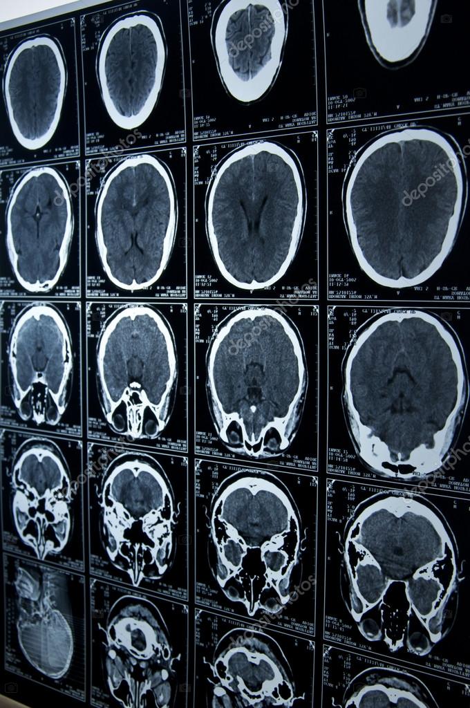 Mri brain scan Stock Photo by ©Meawpong2008 25626933