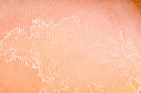 Dry skin texture — Stock Photo © panxunbin #6918503