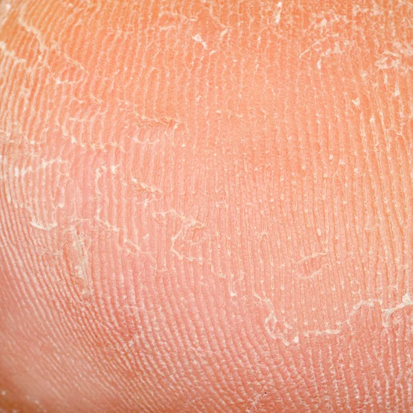 Dry skin texture — Stock Photo © panxunbin #6918503