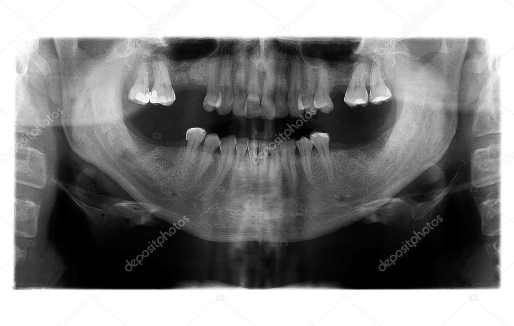 Radiografía dental panorámica con dientes 2022