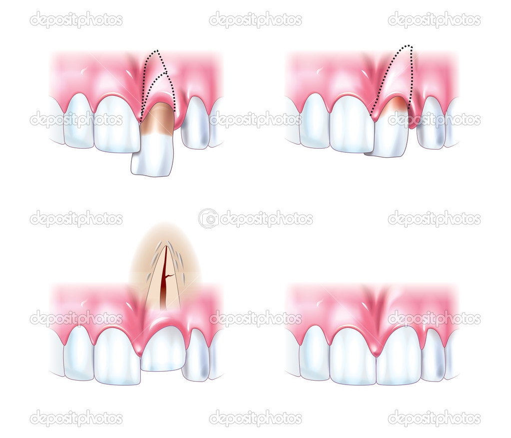 Esquema dislocaciones dientes 2024