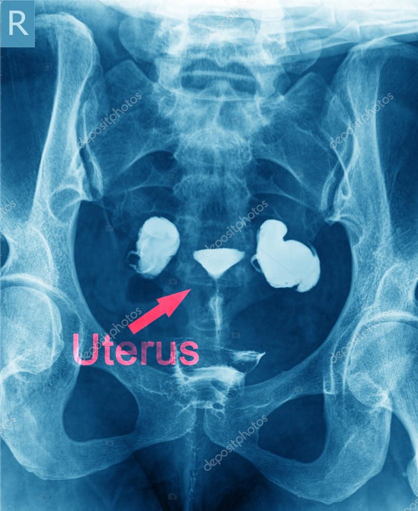 X ray of Uterus — Stock Photo © wonderisland #27236423