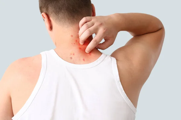 Teenager Ill Monkeypox Light Background Closeup Stock Photo by ...