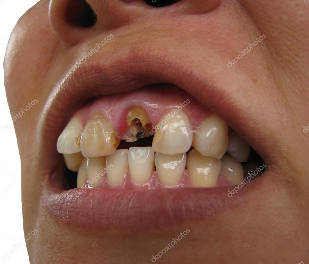 Broken tooth — Stock Photo © olovedog1 #12782960