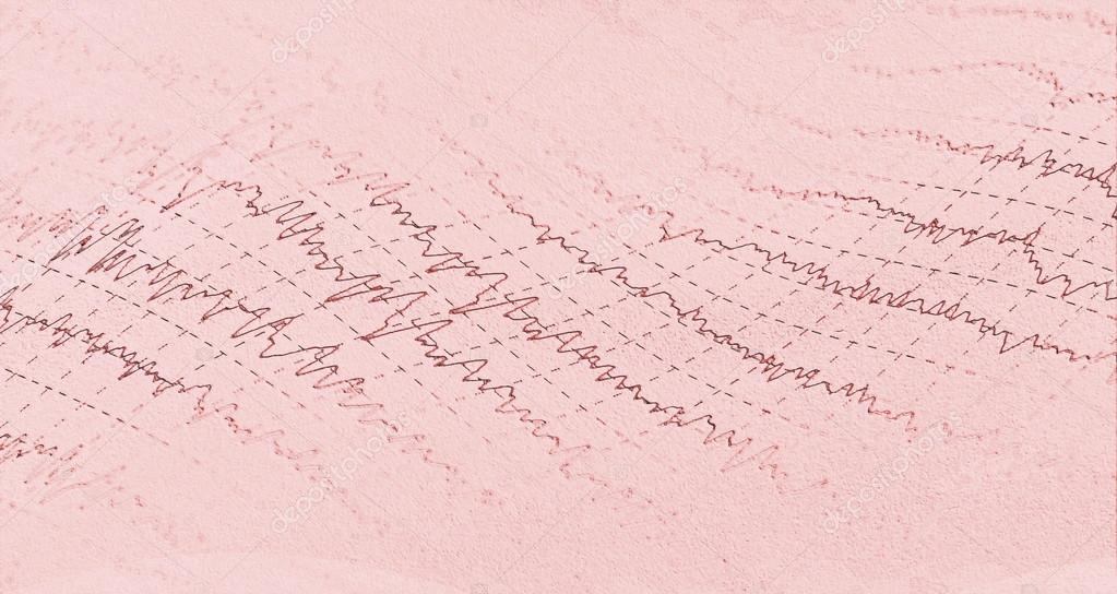 Brain wave electroencephalogram EEG for epilepsy Stock Photo by ...