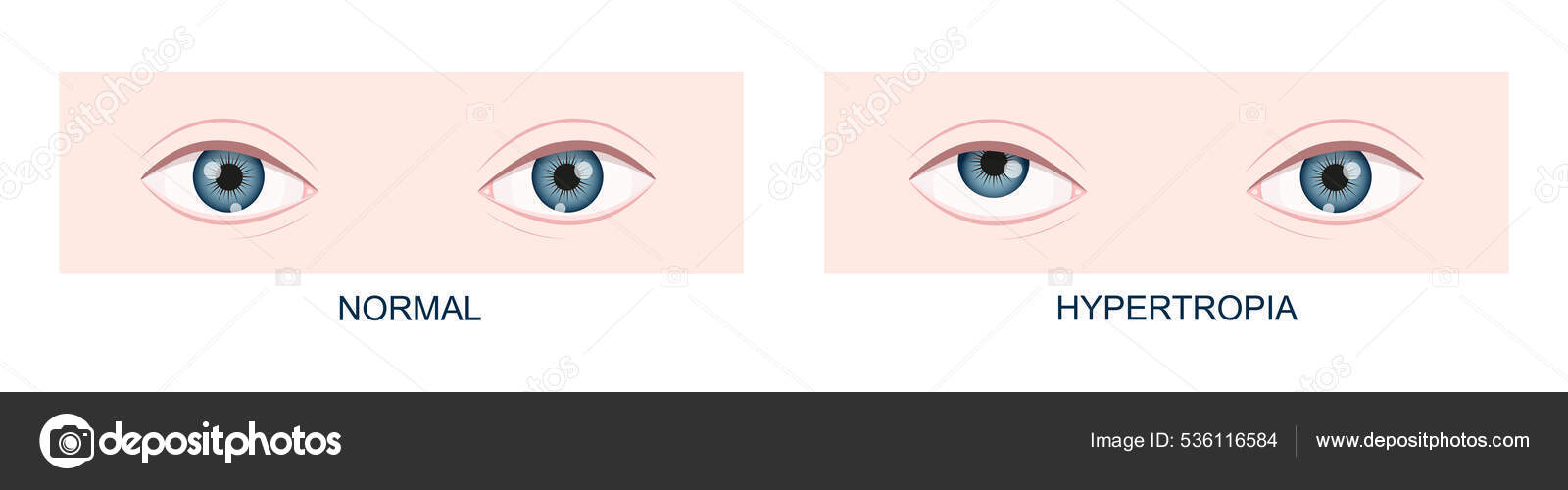 Hypertropia. Vertical strabismus before and after surgery. Human eyes ...
