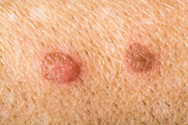 Infecciones de la piel fotos de stock, imágenes de Infecciones de la ...