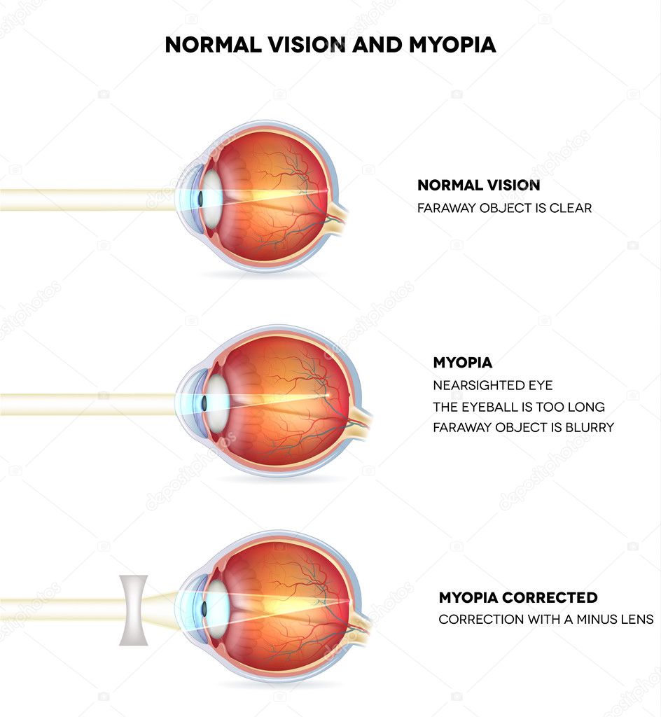 Myopia and normal vision. Myopia is being shortsighted. Stock Vector ... Myopia and normal vision. Myopia is being shortsighted. Stock Vector ...