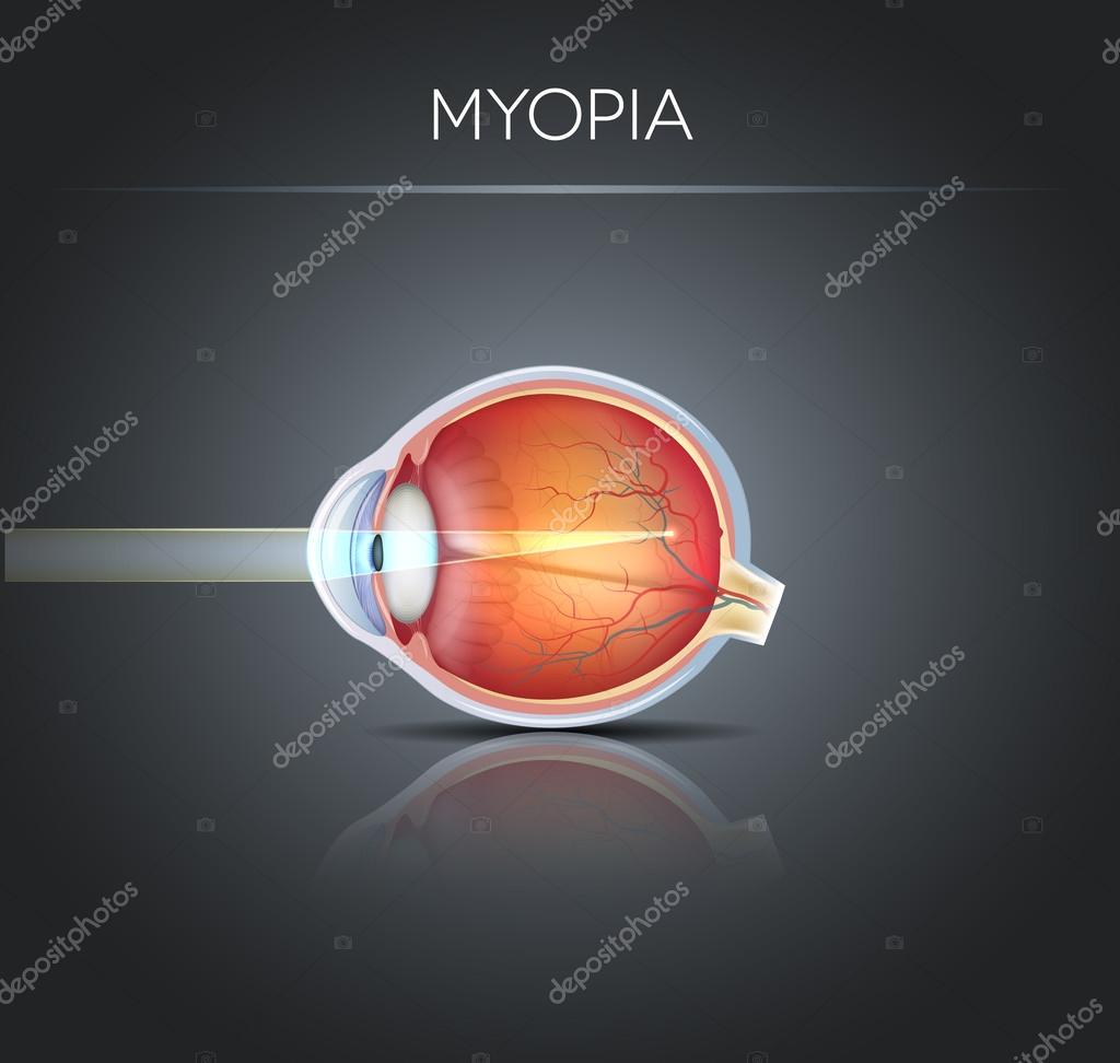 Human vision disorder, Myopia. Myopia is being shortsighted. Stock ...