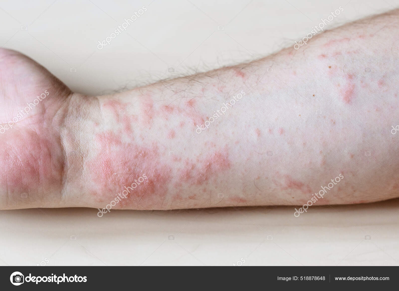 Muestra Dermatitis Alérgica Contacto Erupción Con Picor Costado Del ...