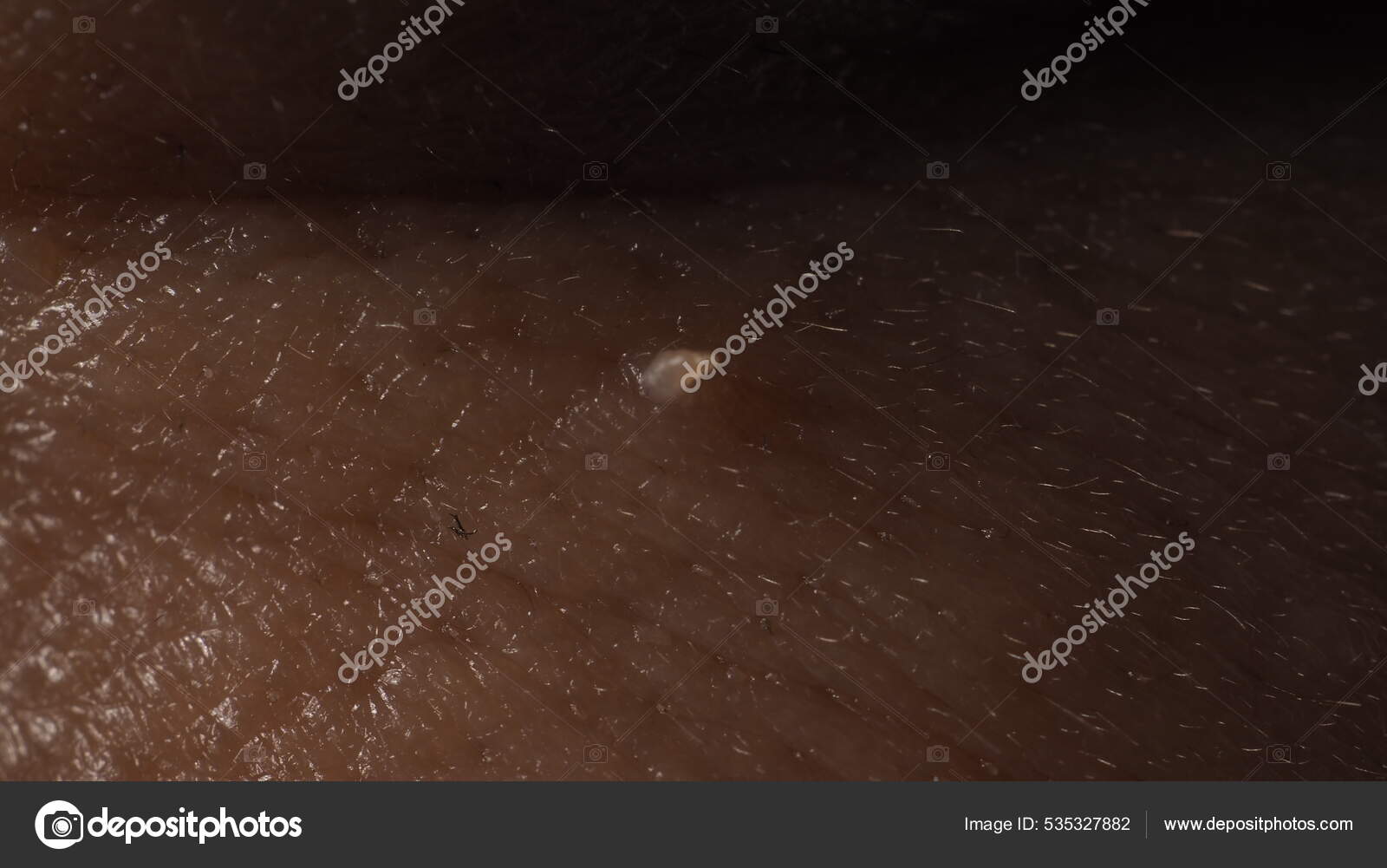 Wart Face Macro Shot Wart Eye Papilloma Skin Eye Nose — Stock Photo ...