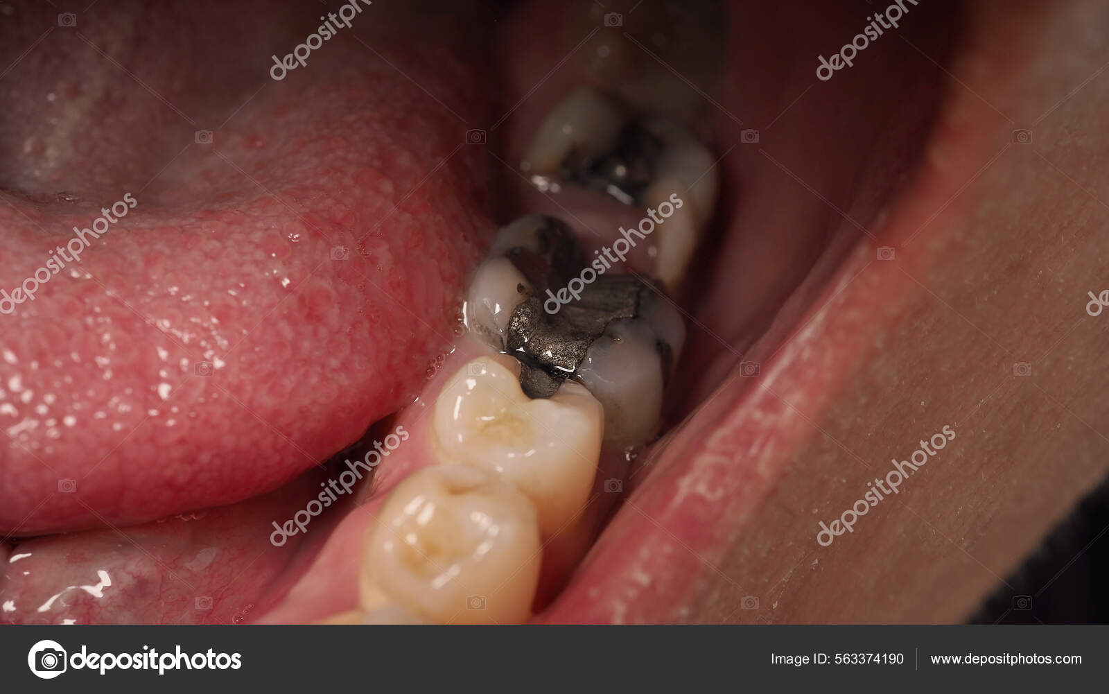 Decayed Tooth Root Canal Treatment Tooth Teeth Decay Lower Molar Stock ...