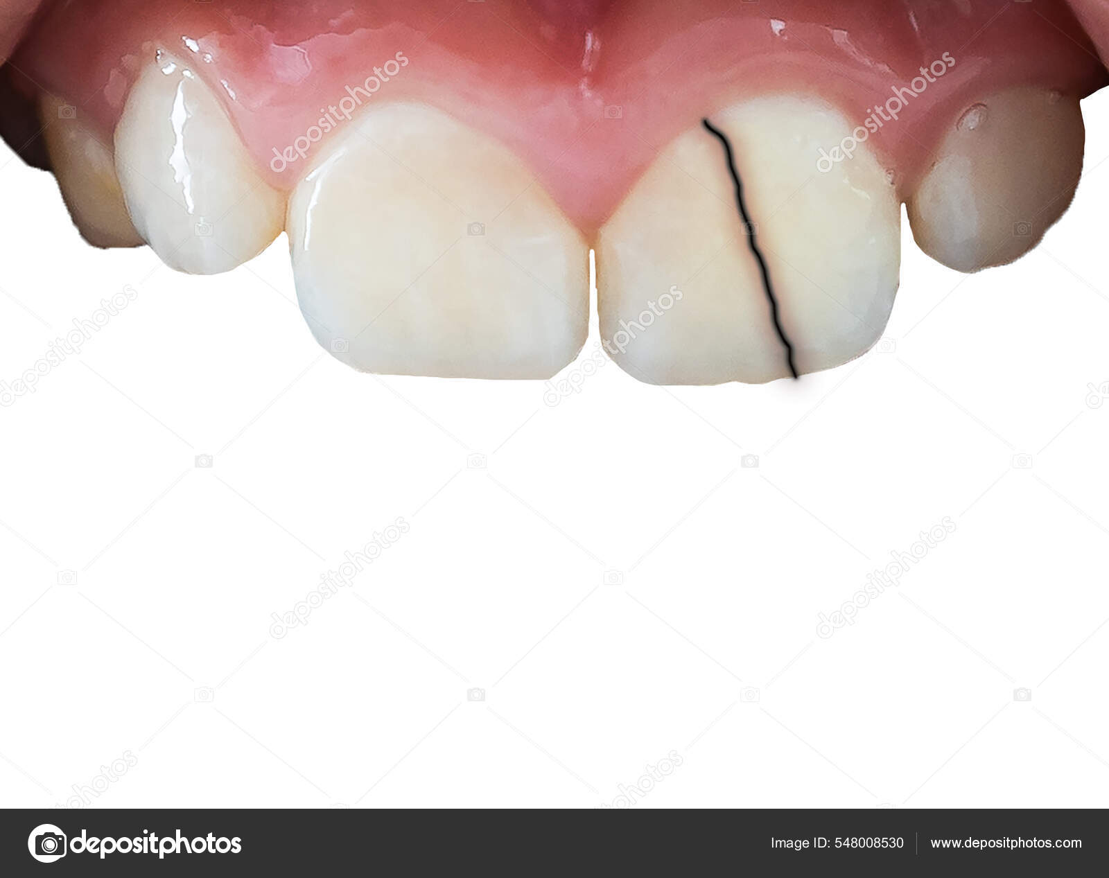 Spoiled, rotten tooth concept illustration. Isolated background — Stock ...