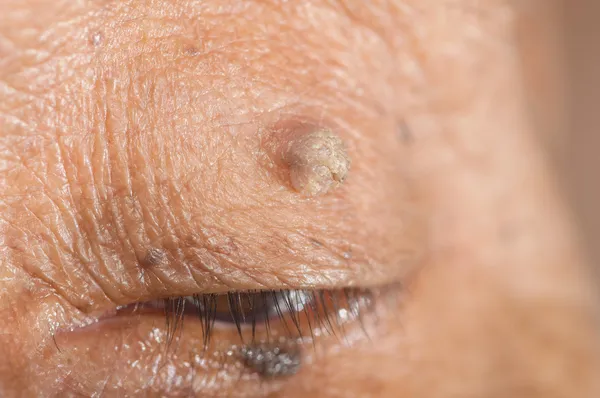 White Skin Tags On Face