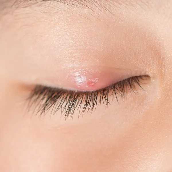 Eye lid abscess "stye" - Stock Image - Everypixel