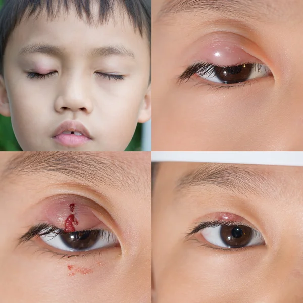 Stye Treatment Kids