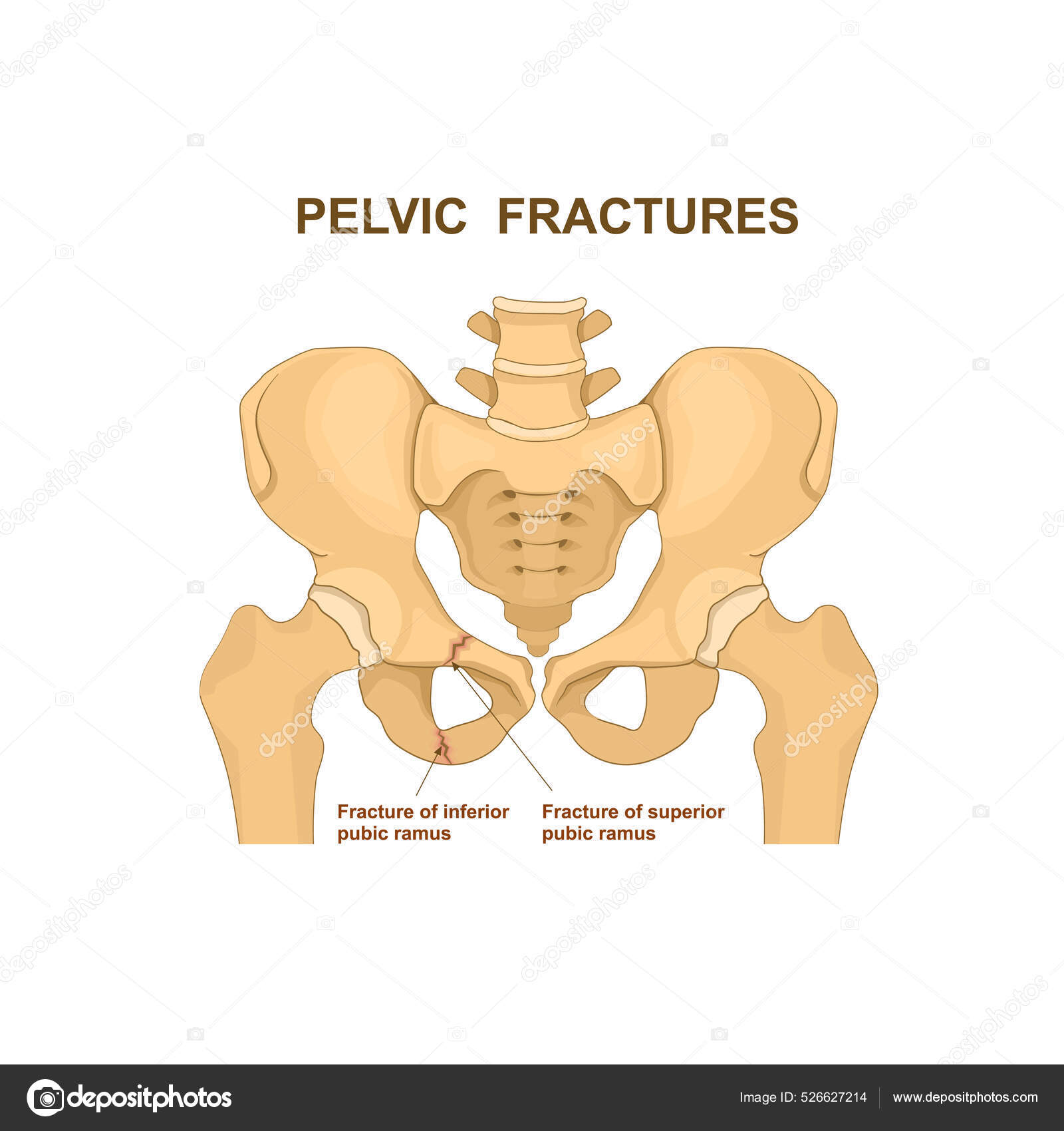 Fracture Of The Pelvic Bones Superior And Inferior Pubic Ramus Fracture Stock Vector By
