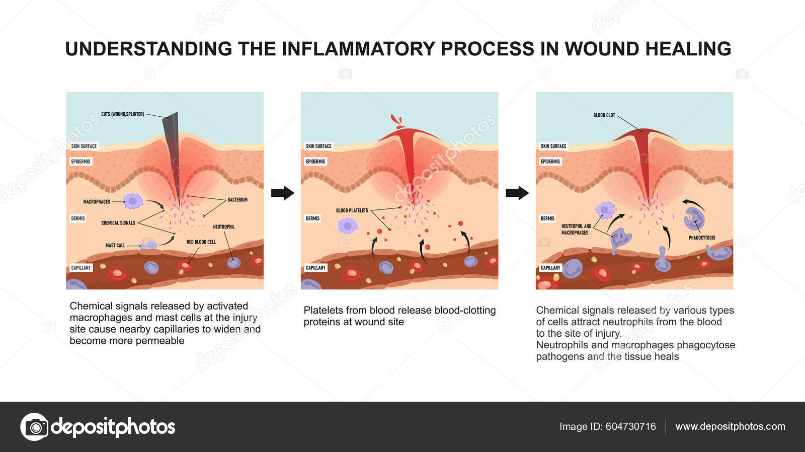 Understanding Inflammatory Process Wound Healing vector, gráfico ...