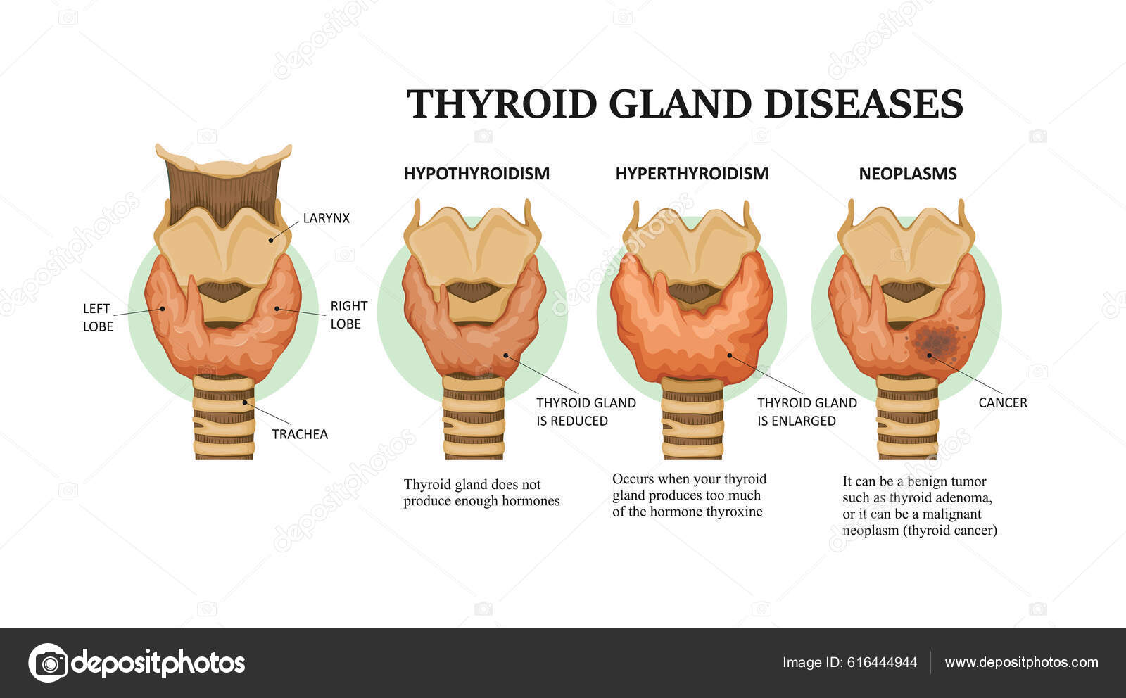 Thyroid Gland Diseases Hyperthyroidism Hypothyroidism Neoplasms Stock ...