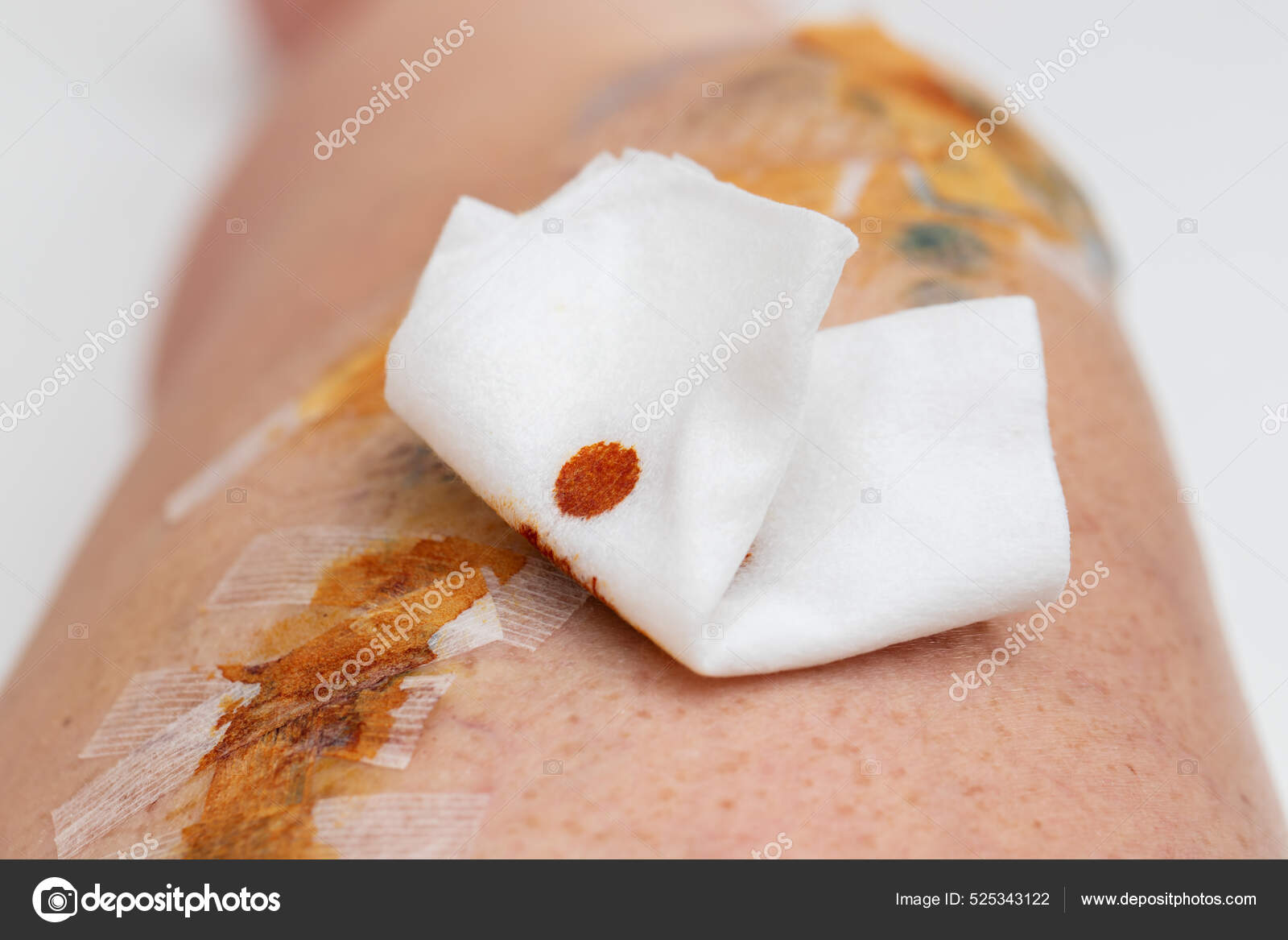 Leg White Patches Varicose Veins Treatment — Stock Photo ...