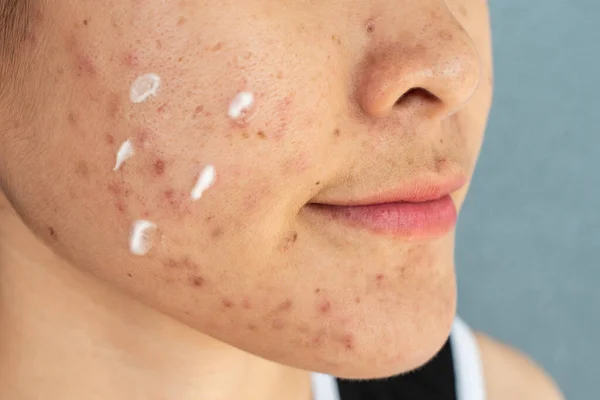 Portrait Worrying Woman Problems Acne Inflammation Papule Pustule Her ...