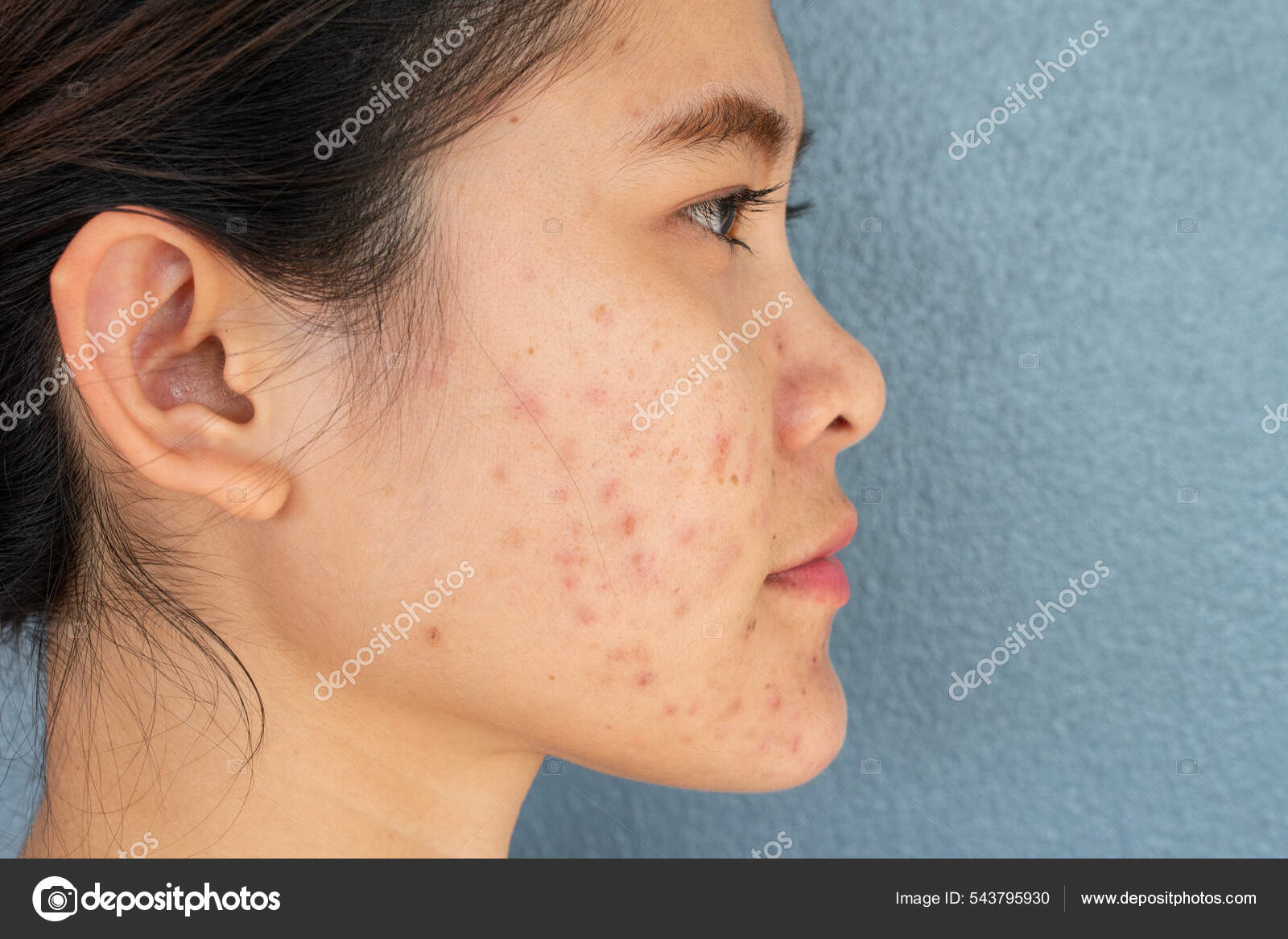 Papule Acne