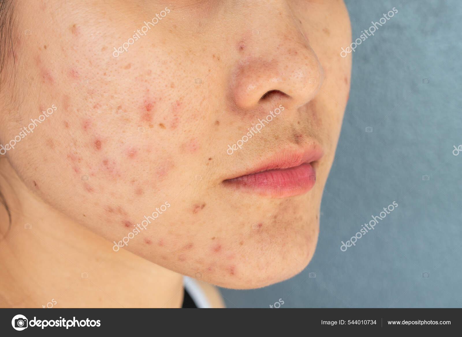 Close Woman Half Face Problems Acne Inflammation Papule Pustule Her ...