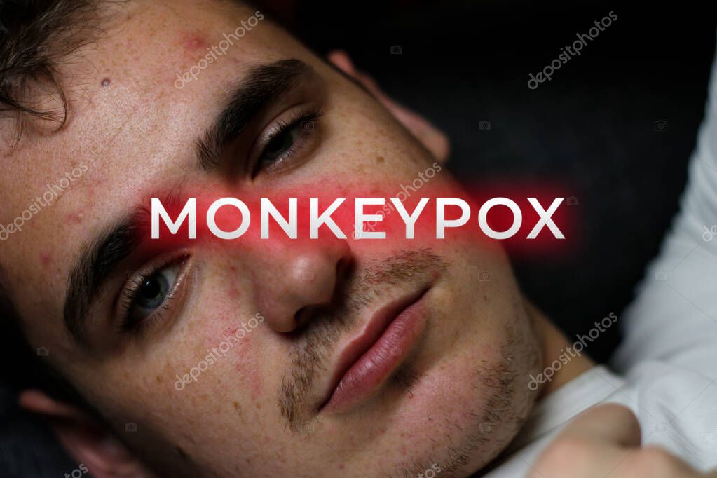 Virus de la gente joven. Monkeypox nueva enfermedad peligrosa en el ...
