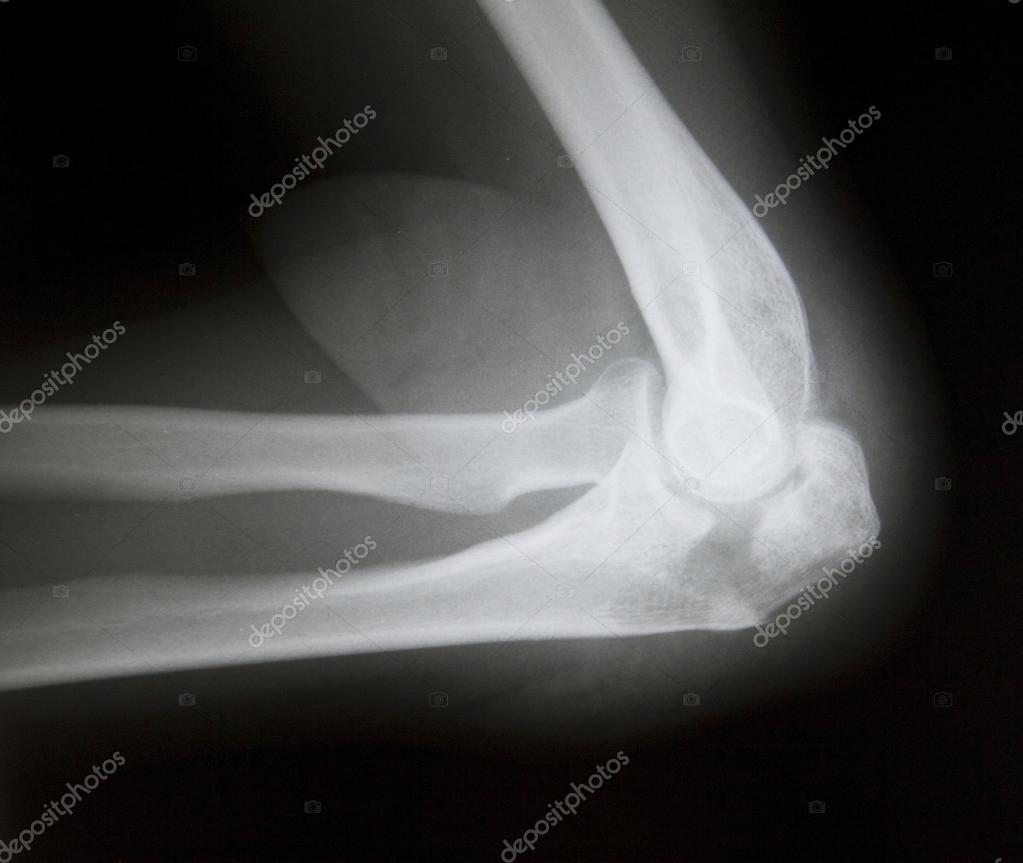 Imagen de rayos X del codo roto — Foto de stock #28944913 © patrisyu